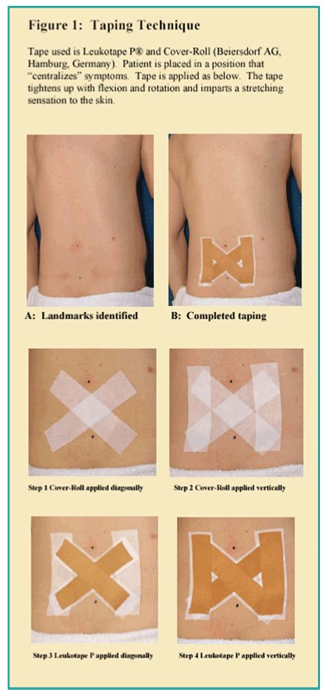 Use Of Taping To Maintain Centralization In A Patient With Low Back