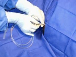 Procedure Steps For Paracentesis Position During An Emergency