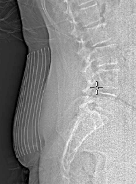 Lumbar Epidural Steroid Injection L4 L5 At Ashley Bruny Blog