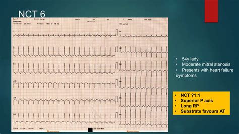 Narrow Complex Tachycardiasupraventricular Tachycardia Pptx