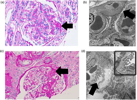 Monogenic Focal Segmental Glomerulosclerosis A Conceptual Framework For Identification And