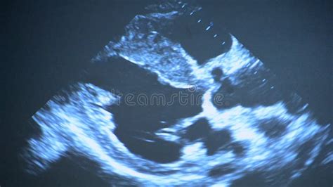 Utrasound Image On Monitor Ultrasound Scan Display Screening Ultrasonography Stock Video