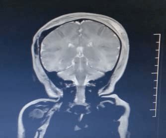 Mri Showing Subgaleal Hematoma Download Scientific Diagram
