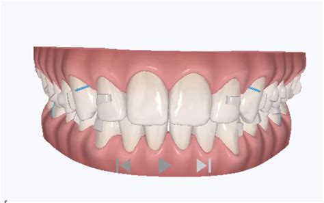 Would Aligners Without Attachments Work Rinvisalign