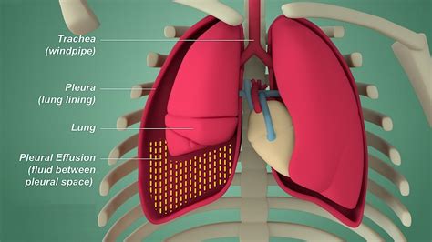 Small Pleural Effusion