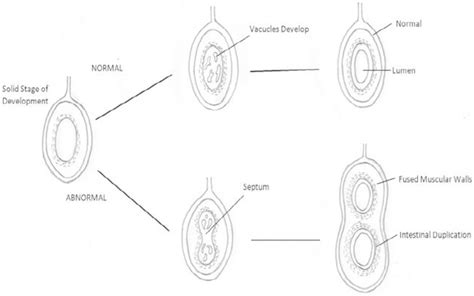 Schematic Representation Showing Intestinal Duplication Reproduced Download Scientific Diagram
