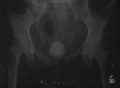 Lupus Cystitis An Unusual Presentation Of Systemic Lupus Erythematosus