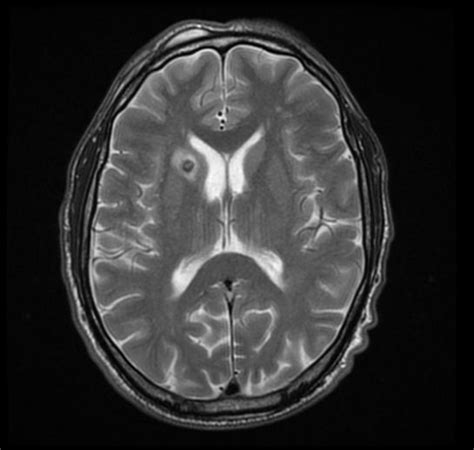 Toxoplasmosis Brain