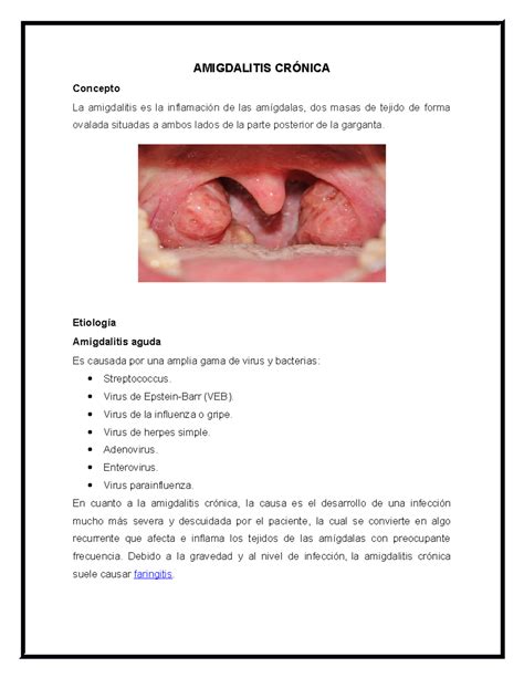 Amigdalitis Severa Trastornos De La Deglución ¿cómo Tratarla 2024