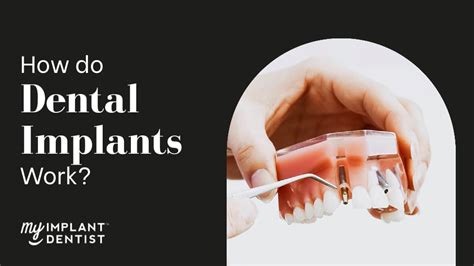 How Do Dental Implants Work My Implant Dentist