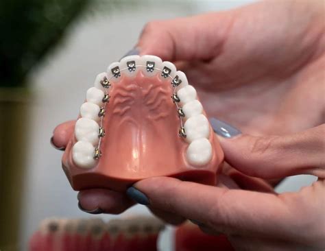 Lingual Braces Inside Braces Laski Orthosmiles