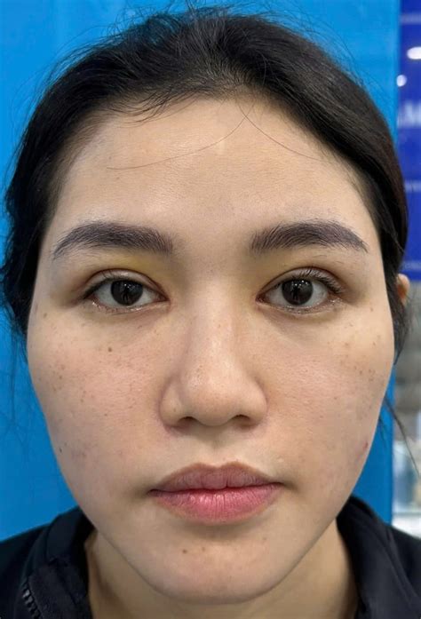 HỘi Kinh NghiỆm CẮt MÍ SỬa LẠi MÍ HỎng SỬa MÍ BẨm Sinh Sẹo Chỗ Góc Mắt Khó Trị Không Mọi