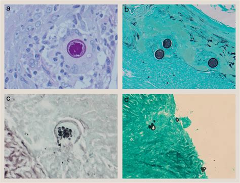A Histopathological Approach To Diagnosis And Classification Of