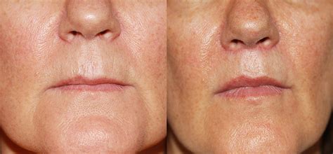 Upper Lip Lift Before And After Lip Lift Surgery Before And After