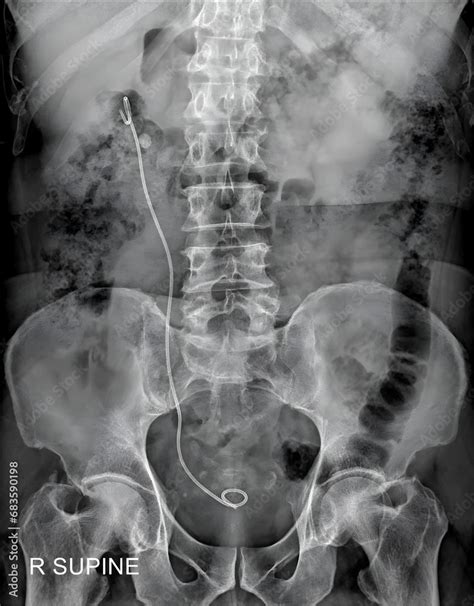 Stock Foto „ X Ray Kub Imaging Radiographic Evaluation Of Ureteral Jj