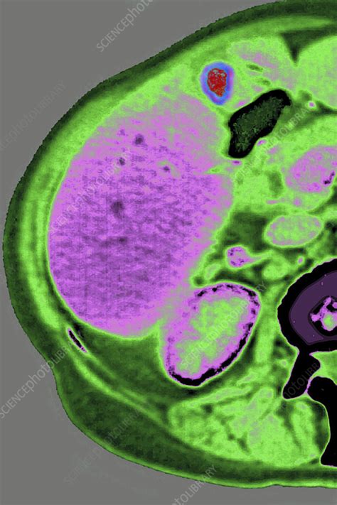 Lymphoma Ct Scan Stock Image C0602219 Science Photo Library