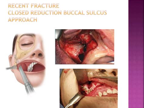 Zygomatic Complex Fracture Pptx