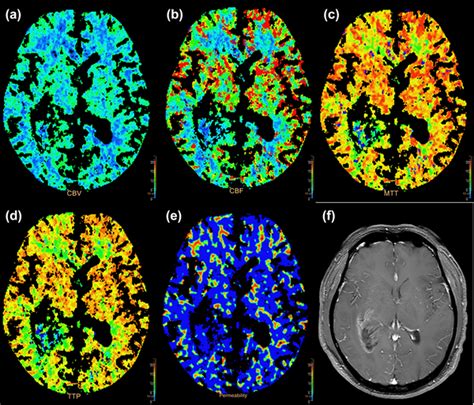 30yearold Man With A Glioblastoma Of The Right Temporal Lobe WHO IV Download Scientific