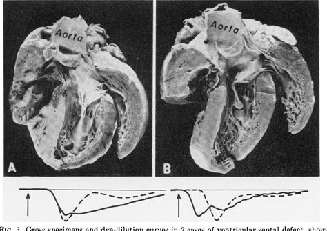Figure 1 From Functional Pathology Of The Pulmonary Vascular Tree In