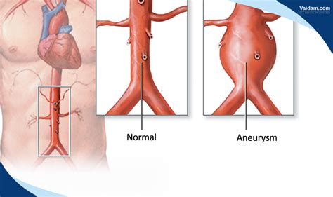 Arterial Aneurysm Treatment In India Comprehensive Care For A Life