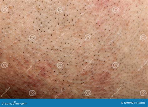 Razor Rash Stock Photos Free Royalty Free Stock Photos From Dreamstime