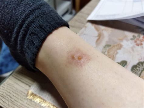 【虫】腫れ・内出血・水ぶくれ！謎の毒虫に刺されたので1カ月経過を観察してみた｜古民家移住の教科書