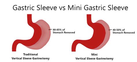 Mini Gastric Sleeve Surgery Procedure Benefits Risks And Recovery Time