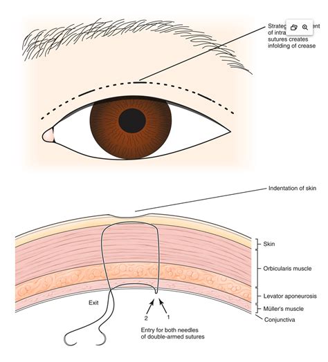 Minimally Invasive Double Eyelid Surgery 6 Suture Ligation Methods For