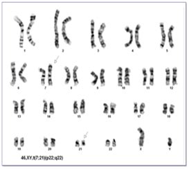 Unique RUNX1 Gene Rearrangements In Acute Myeloid Leukemia AML
