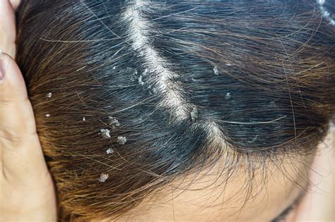 Seborrheic Dermatitis Scalp Hair Loss