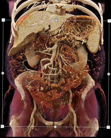 Pancreatic Cancer With Dilated Pancreatic Duct And Incidental Gist