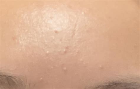 What Are These Bumps On My Forehead Rkbeauty
