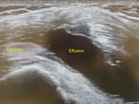 Clinical Cases Archives Ucsd Ultrasound