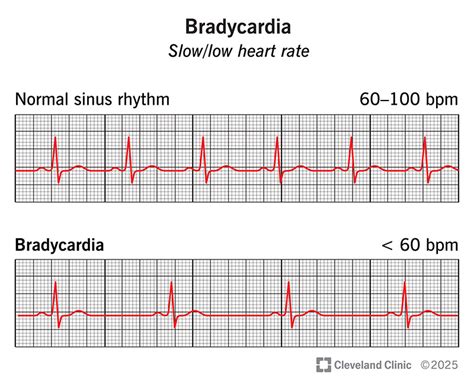 Bradycardia Symptoms Causes And Treatment