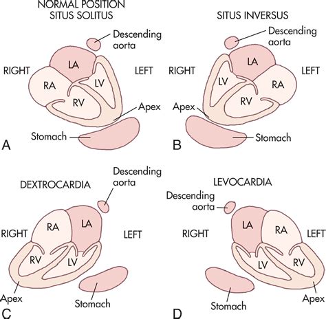 Fetal Echocardiography Congenital Heart Disease Clinical Tree