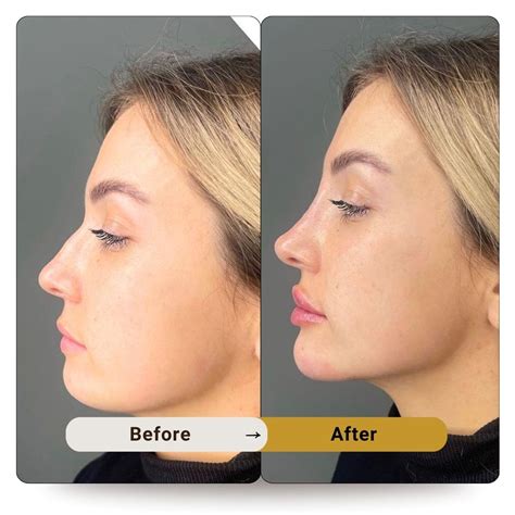 Nose Thread Lift Elite Body Home Polyclinic