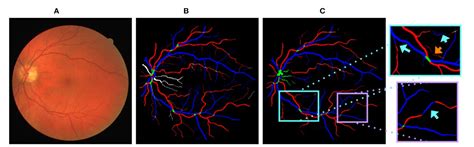 Figure 1 From Vtg Net A Cnn Based Vessel Topology Graph Network For Retinal Arteryvein
