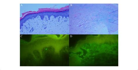 Skin Biopsy Indicates Subacute Lupus Erythematosus A Sporadic