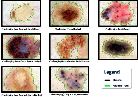 Probabilistic Models In Automated Skin Lesion Diagnosis