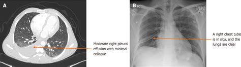 Left Haemothorax