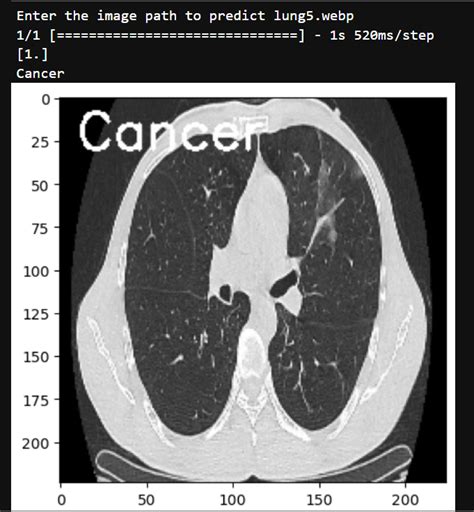 Github Parththaker Diagnosis Of Lung Cancer Using Ai The Project I Have Created Using The