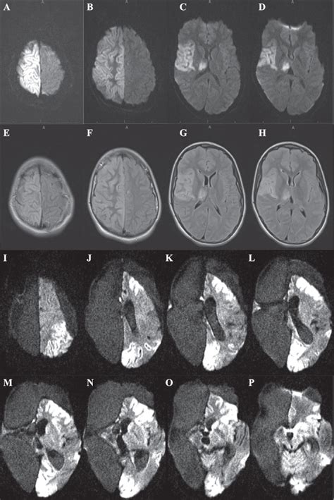 Initial Mri Demonstrating Extensive Areas Of Restricted Diffusion Download Scientific Diagram