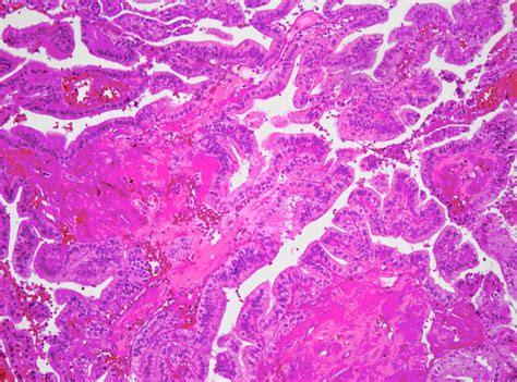 Choroid Plexus Papilloma The Image Shows A Well Differentiated
