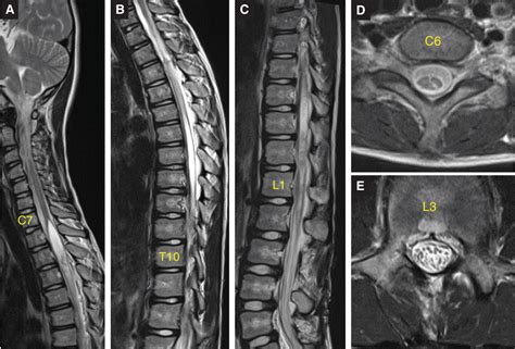 Table 1 From Syringo Peritoneal Shunt For Syringomyelia Due To