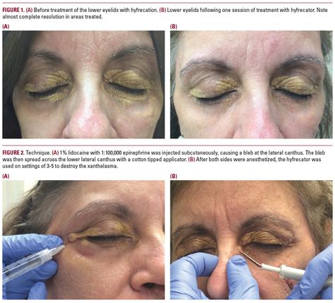 Electrodessication For Xanthelasma At Jesse Lyles Blog