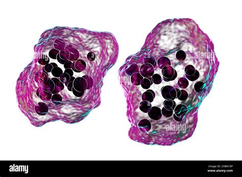 Illustration Of Measles Virus Infection Showing Giant Multinucleated