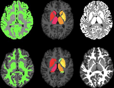 Automatic Segmentation Of The Gray Matter Gm Top Left And The White
