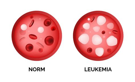 What Is Acute Myeloid Leukemia
