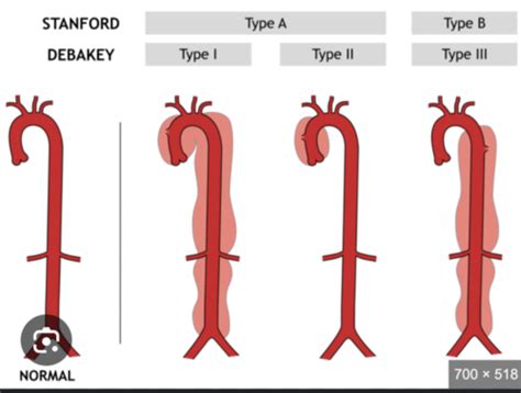 Aortic Dissection Flashcards Quizlet