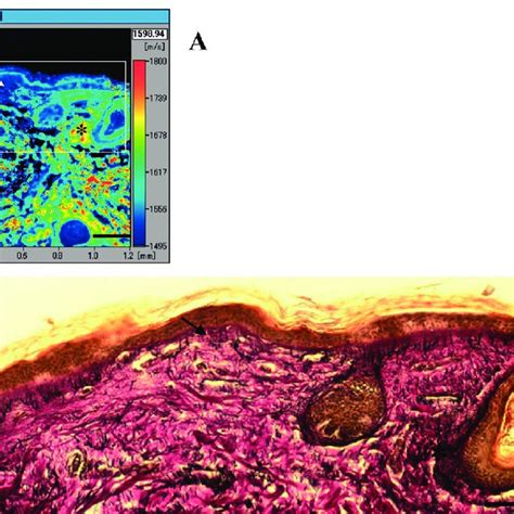 Concept Of Ultrasonic Microscopy For Tissue Characterization